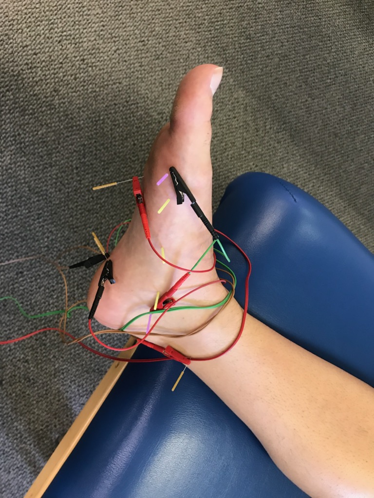 Dry Needling, Perspective from a Certified PT - Desert Hand and ...